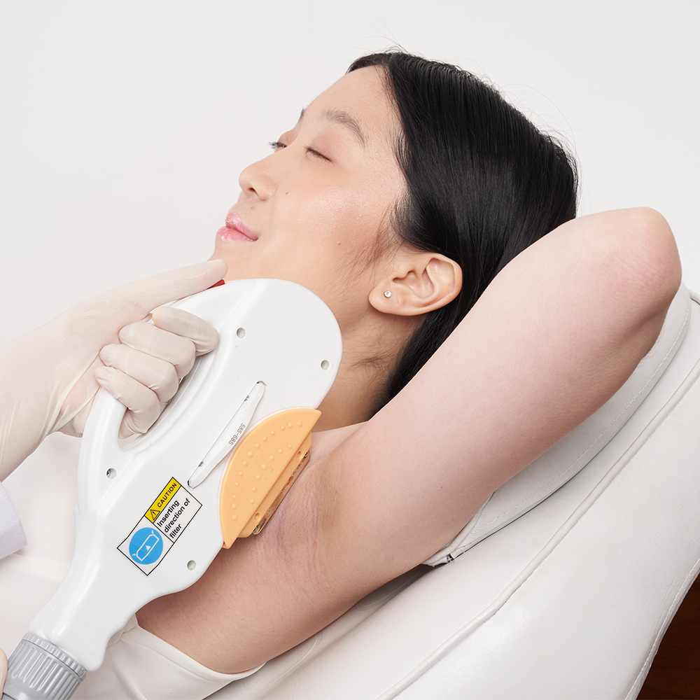Hair Removal for Under Arms by IPL (Solari)