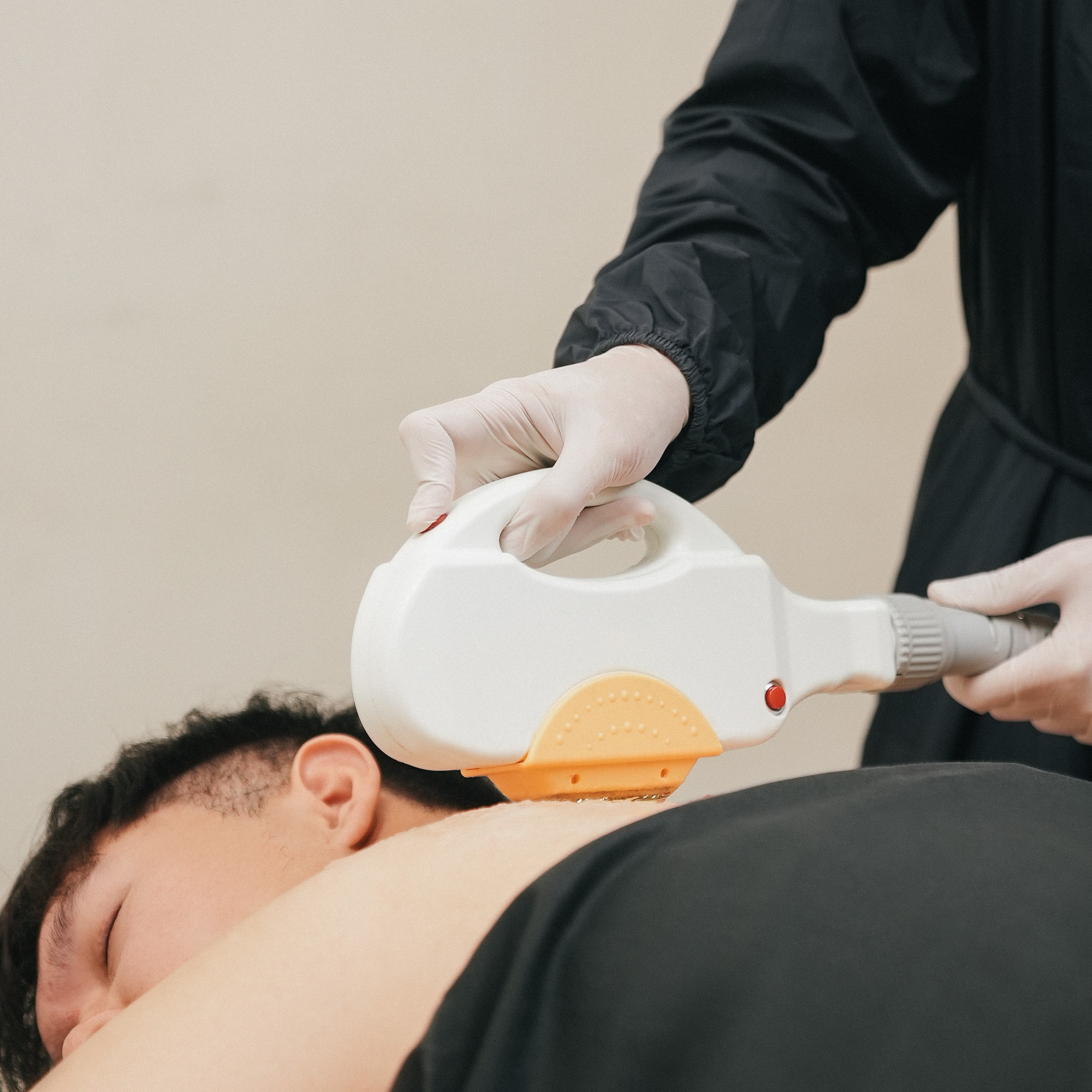 No Back Acne Treatment By Ipl