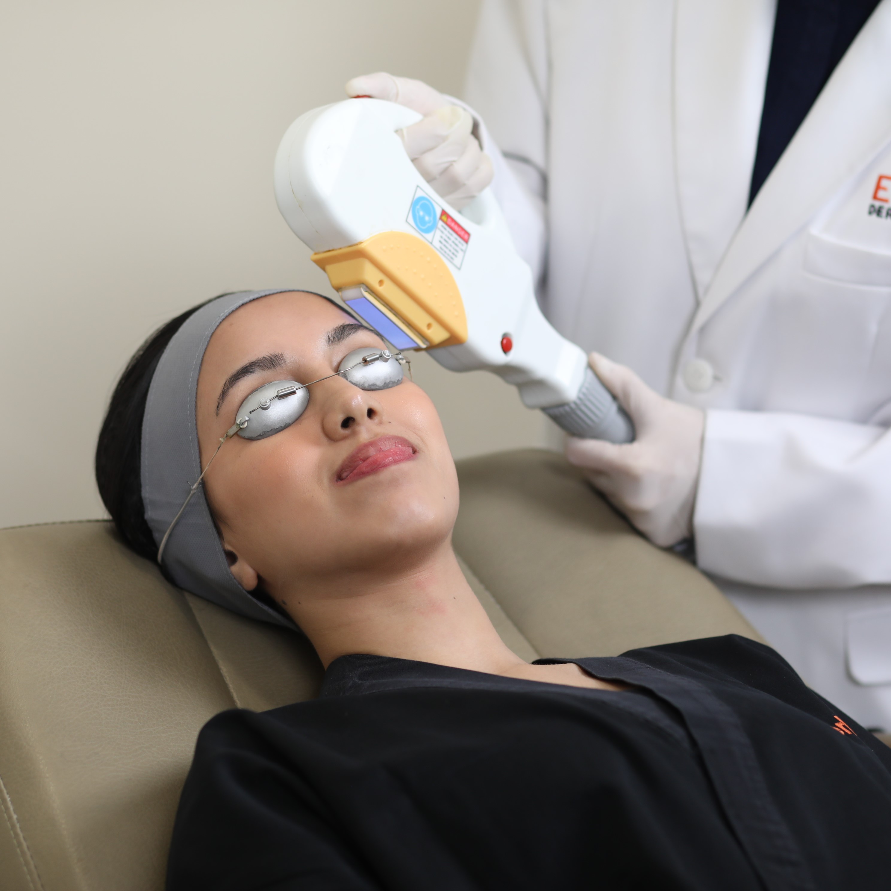 Active Acne Therapy by IPL