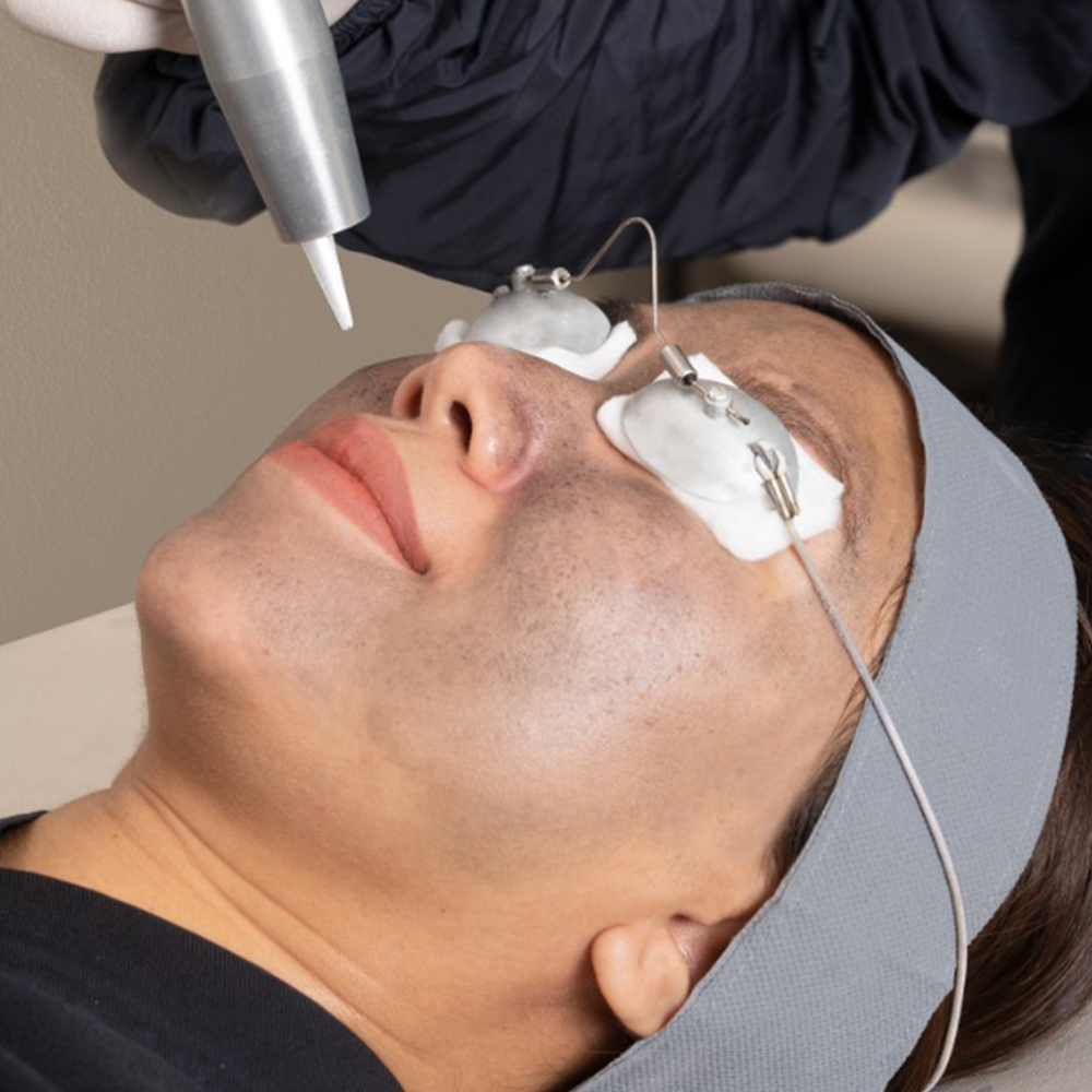 Black Carbon Glowrejuvenation Laser for Full Face - HEL